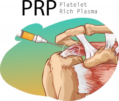 PRP for Shoulder Impingement: Heal Without Surgery - RegeneVive Health ...