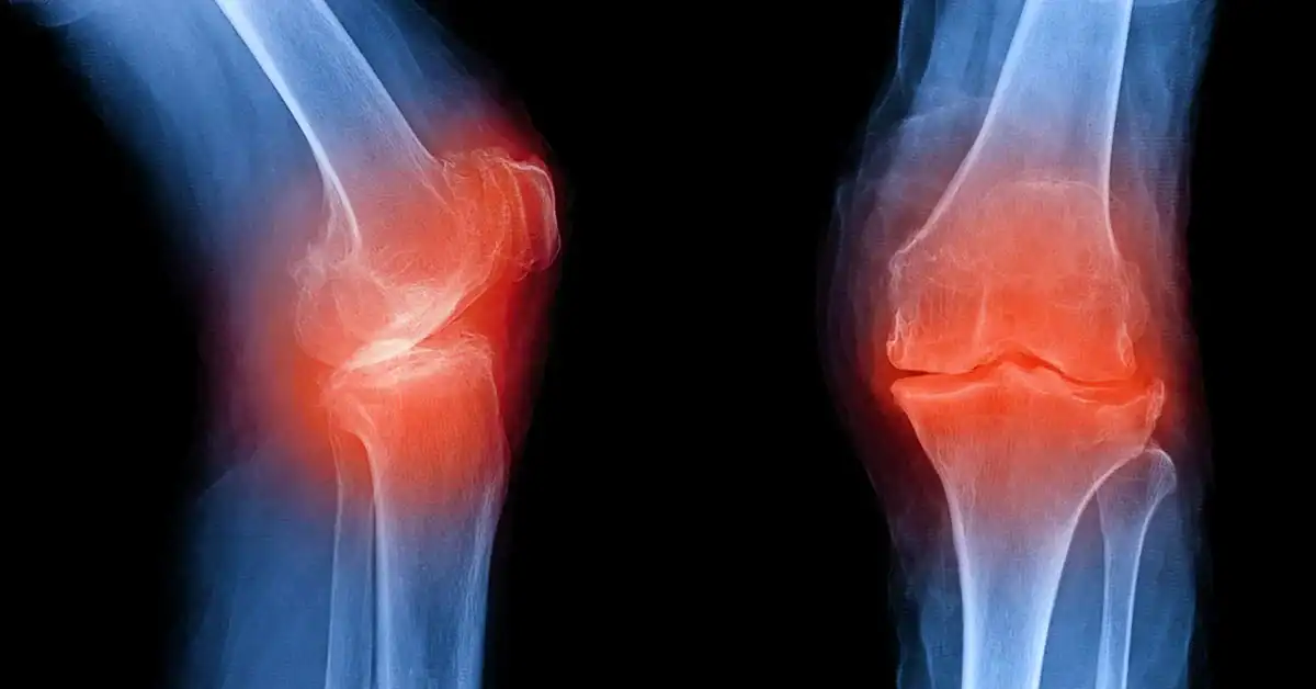 Understanding Subchondral Sclerosis and Regenerative Treatment Options